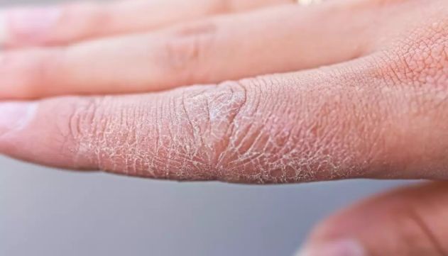 DISIDROSE O que é, causas, sintomas e tratamento - khondrion.com